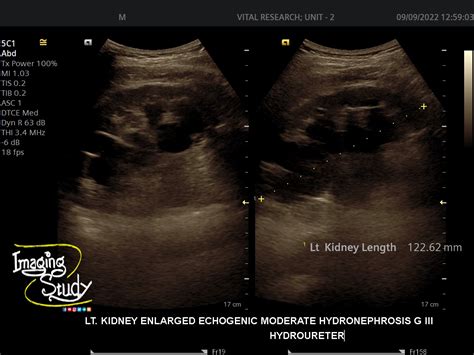 Case 81 Bilateral Ureteric Calculi Causing Obstructive Uropathy
