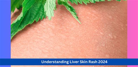 Liver Skin Rash Insights Into Causes Symptoms And Treatment Us