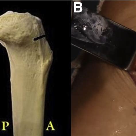 Pdf Modified Elmslie Trillat Procedure For Distal Realignment Of