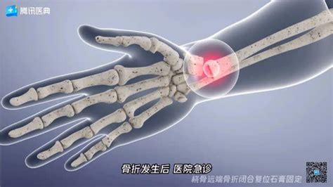 桡骨远端骨折闭合复位石膏固定腾讯视频