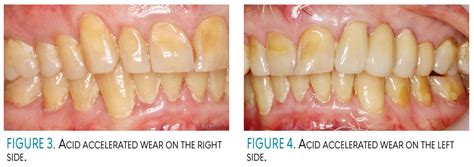The Complexities Of Erosive Tooth Wear Dimensions Of Dental Hygiene