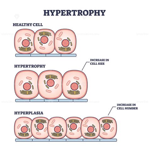 Hypertrophy Hyperplasia Or Healthy Muscular Cells Comparison Outline