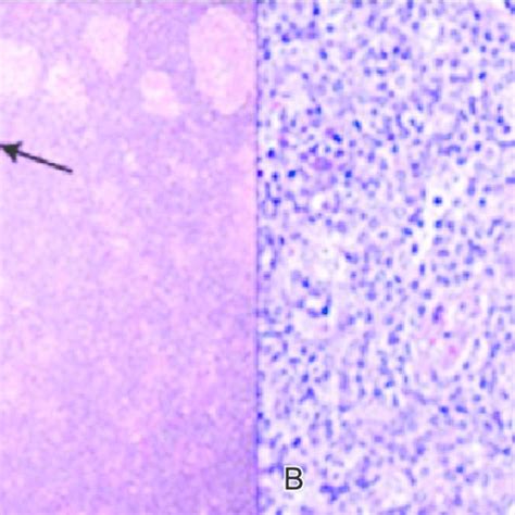 Photomicrography Histologic Examination Of The Intraparotid Lymph