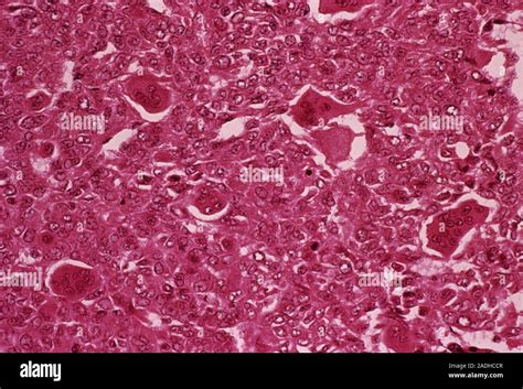 Thyroid Gland Cancer Light Micrograph Of A Section Through A Thyroid Gland Adenocarcinoma The