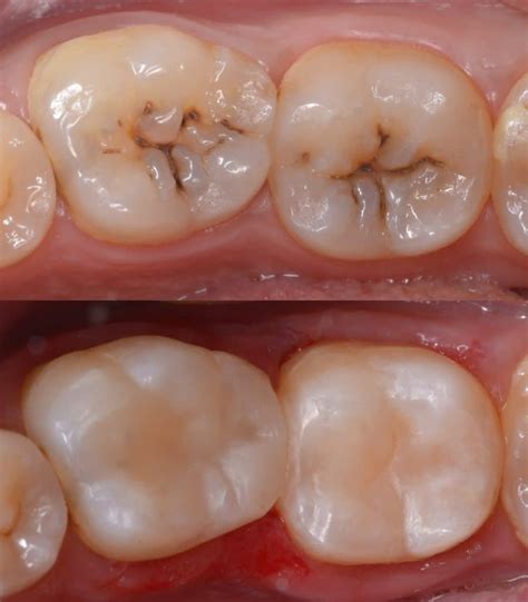 A Recipe For Class Ii Composite Restoration Myzerodonto A Recipe For Class Ii Composite Restoration Myzerodonto