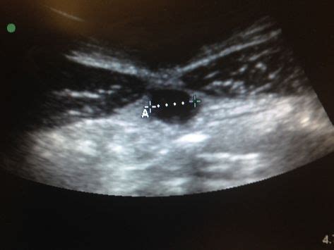 Urachal Cyst Ultrasound