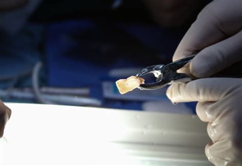 Osteo Odonto Keratoprosthesis Ookp Surgery At Farabi Hospital