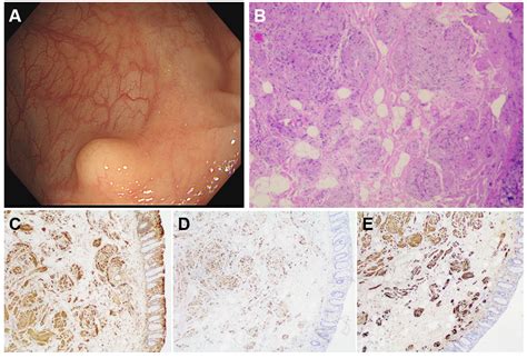 Granular Cell Tumor A Newborn With An Oral Mass Non Neural Granular