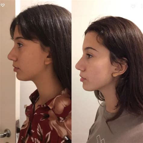 Mewing Before And After 122 Progress Photos Male And Female Transformations