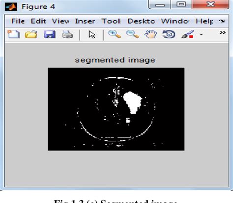 Figure 11 From Brain Tumor Detction And Segmentation Using Histogram Thresholding Semantic