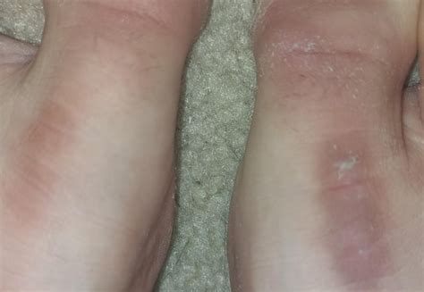 What Is This On Top Of My Toes Rmedical