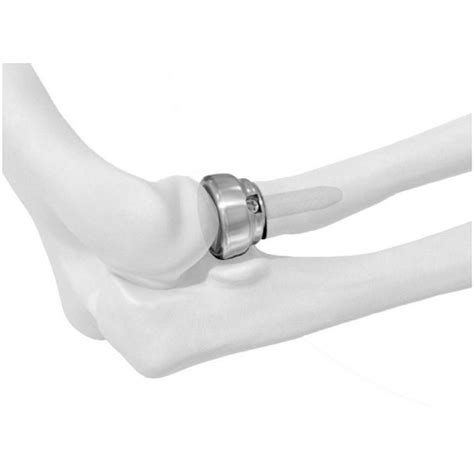 Radial Head Prosthesis At Best Price In New Delhi By Siora Surgicals