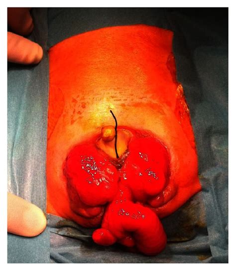 Cloacal Exstrophy Repair With Primary Closure Of Bladder Exstrophy A