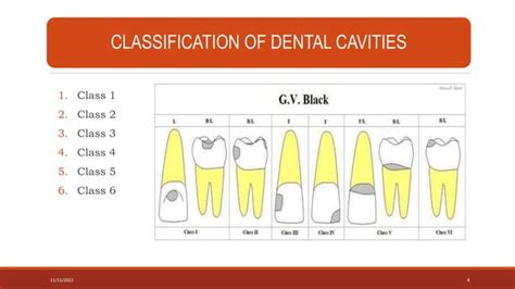 اصول اماده سازی کلاس دوم ، Class 2 Cavity Preparationpptx