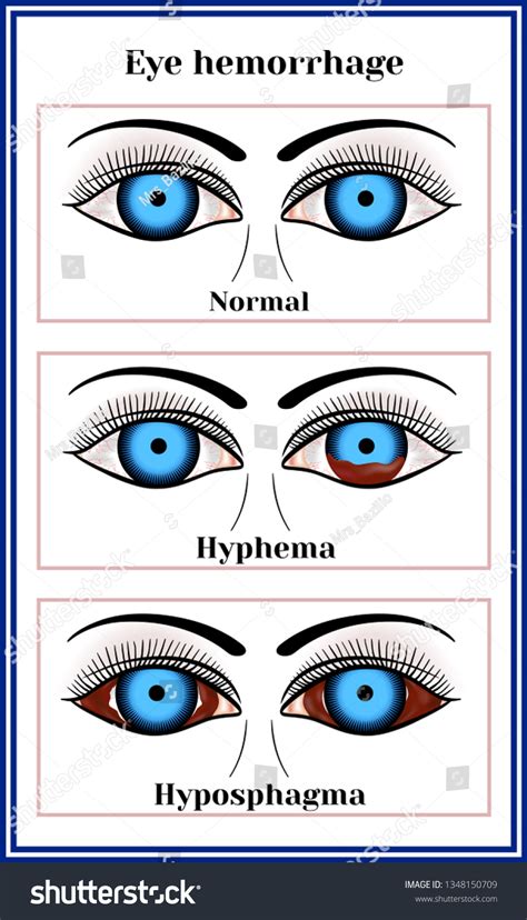 Hyphema