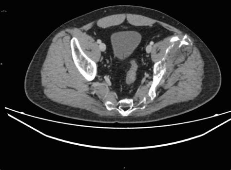 Gorham Stout Disease Case 33 Springer Nature Link