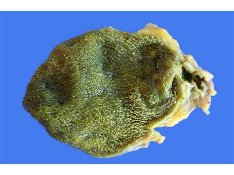 Grossing Of Gastrointestinal Specimens Pptx