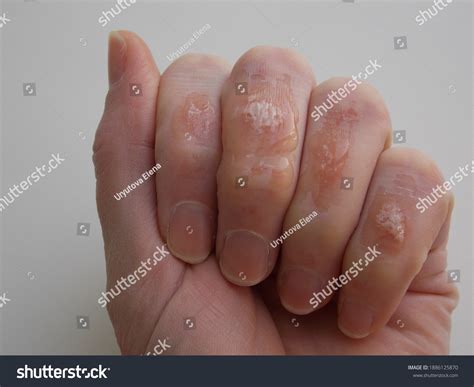Minor Chemical Burns On Hands