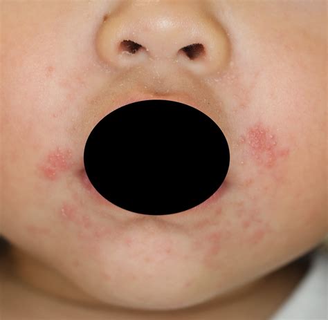 口の周りの湿疹ぶつぶつが治らない。子供にも多い口囲皮膚炎 咲くらクリニック