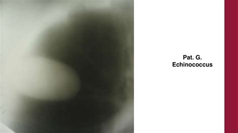 Lung Tuberculoma презентация онлайн