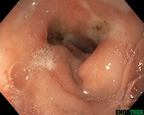 Ulcera Duodeni Endothek