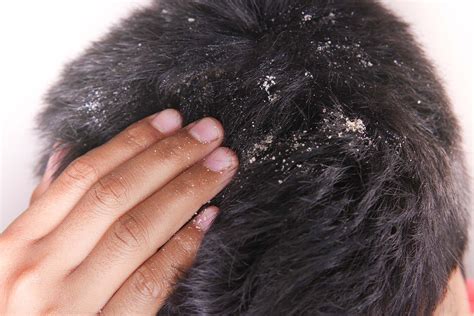 Scalp Sos Dealing With Seborrheic Dermatitis Treatment