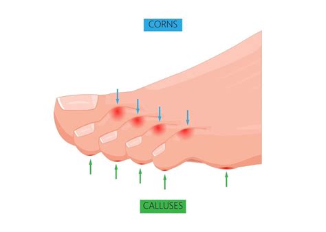 Difference Between Corn And Callus 4 Astonishing Differences Icy Health