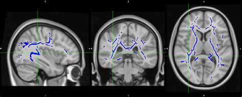 Associations Between 72 H Resilience And 72 H Radial Diffusivity Rd Download Scientific