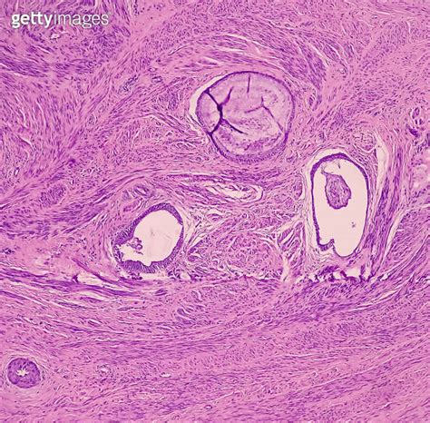 Uterus Biopsy Chronic Cervicitis Leiomyoma Endometriotic Cyst Show