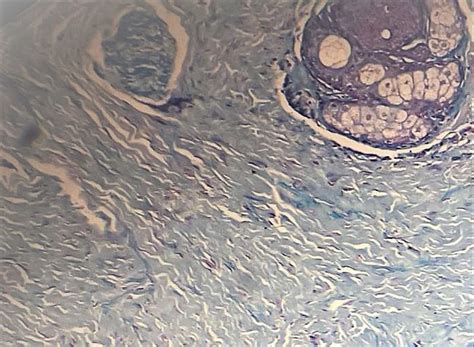 Eruptive Collagenoma A Rare Connective Tissue Hamartoma Presenting