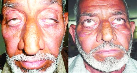 Ptosis Due To Levator Dehiscence Involutional Good Levator Function Download Scientific