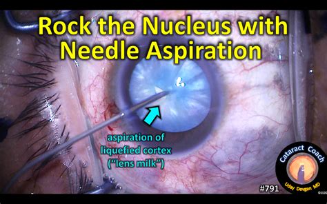 Rock The Nucleus In White Cataracts Cataract Coach™