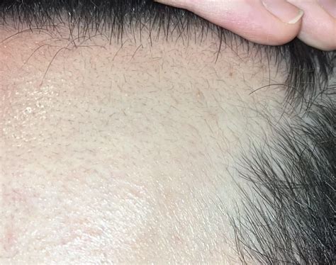 Vellus Hair Itchy At Hayley Chipper Blog