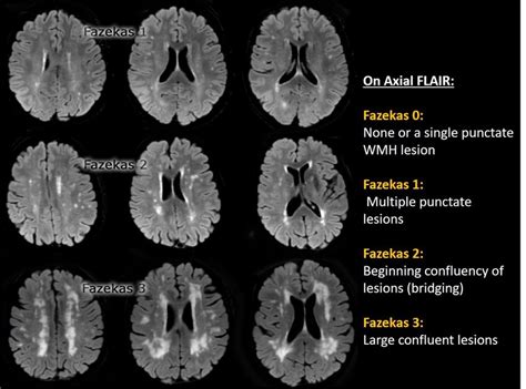 Fazekas Classification Of White Matter Hyperintensities Wmhs Download Scientific Diagram