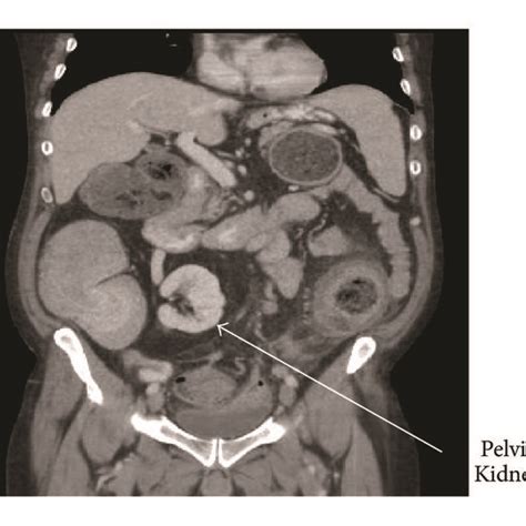 A Coronal View Of Unilateral Crossed Left Renal Ectopia Without
