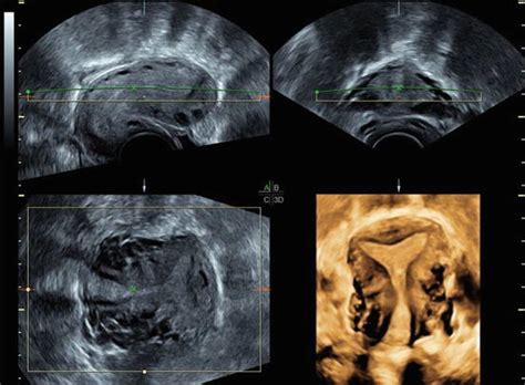 Congenital Uterine Anomalies Obgyn Key