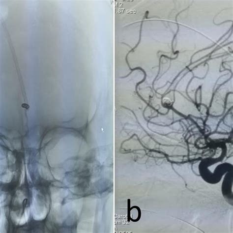 Follow Up Angiogram A Ap View Shows Coils Mass Inside The Aneurysm