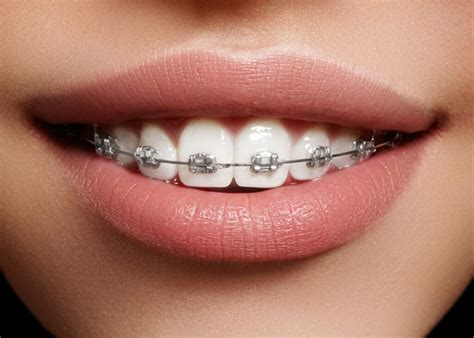 Why Orthodontic Treatment Is Never Too Late For Adults Bellevue Hill
