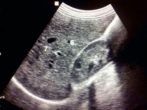 Segmentação Hepática No Ultrassom Retoedu