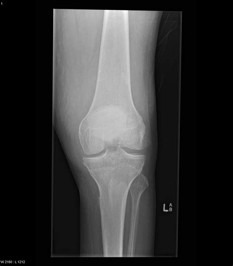 Quadriceps Tendon Calcification