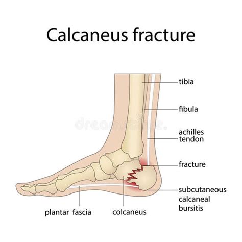 Anatomy Of A Calcaneal Fracture With A Diagram Of The Structure Of A