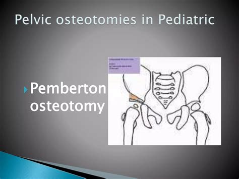 Pelvic Osteotomy In Pediatric Pptx