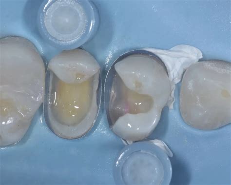 Caries Removal Endpoints Cres — Alleman Center Of Biomimetic Dentistry