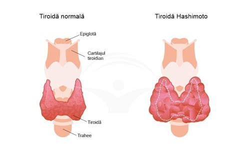 Un Medic Specialist Al Sju Tg Jiu Prezintă Cauzele Simptomele și Tratamentul în Cazul Tiroidei