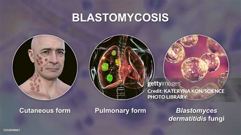 Clinical Presentations Of Blastomycosis 3d Illustration High Res Vector