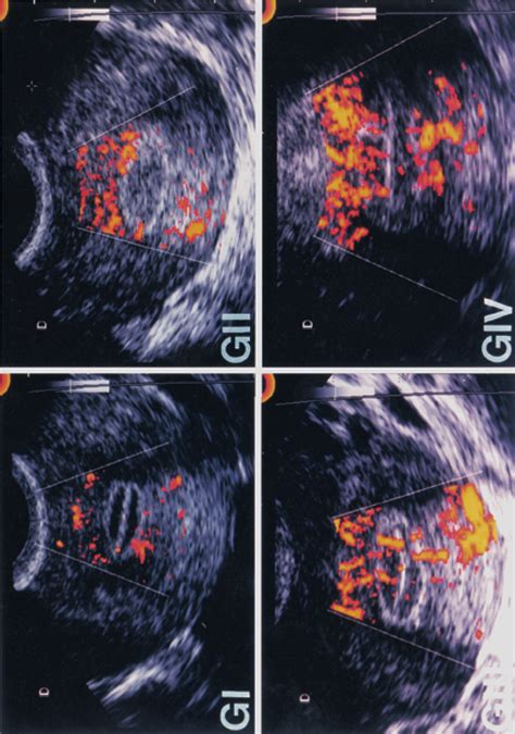Classification Of Endometrial Download Scientific Diagram