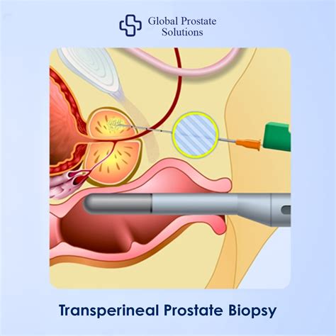 What Is A Prostate Biopsy Latp Biopsy Benefits And Risks
