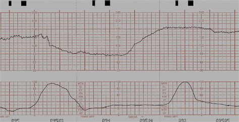 Efm Interpretation Help Obgyn Nursing