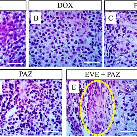 Efficacy Of Treatment Of The Osteosarcoma Pdox Mouse Model On Tumor