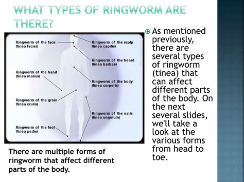 Ppt Ringworm Powerpoint Presentation Free Download Id2634085